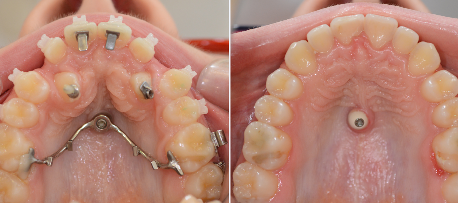 Kieferorthopädische Einstellung verlagerter Eckzähne – ein Fallbericht ...